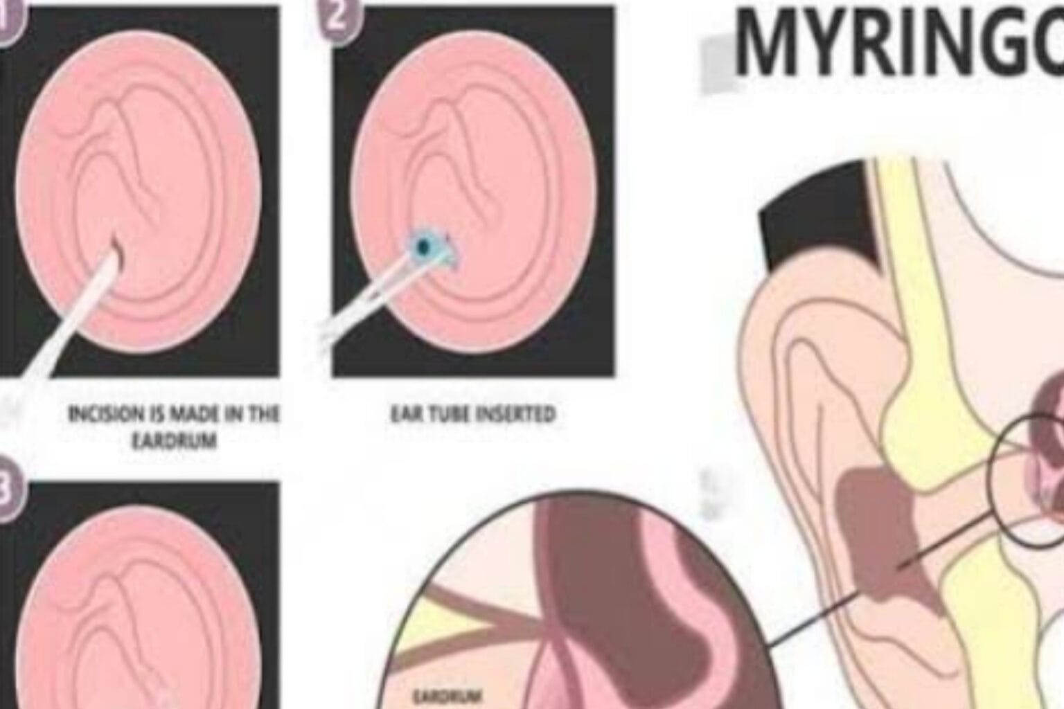 Panduan Lengkap Myringotomy: Prosedur, Manfaat, dan Pemulihan