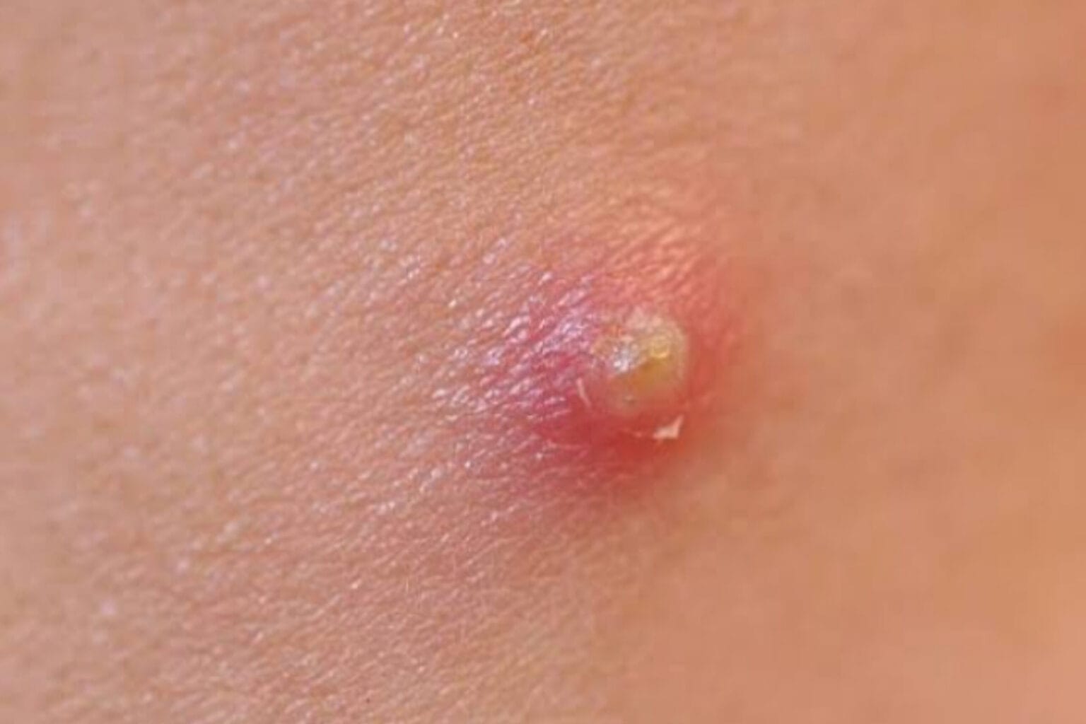 Bisul di Leher? Begini Cara Atasi dan Cegahnya!